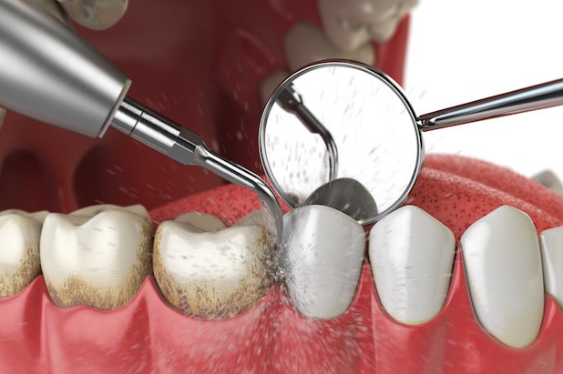 Dentist Teeth Cleaning | Only In One Of The Best In Auckland